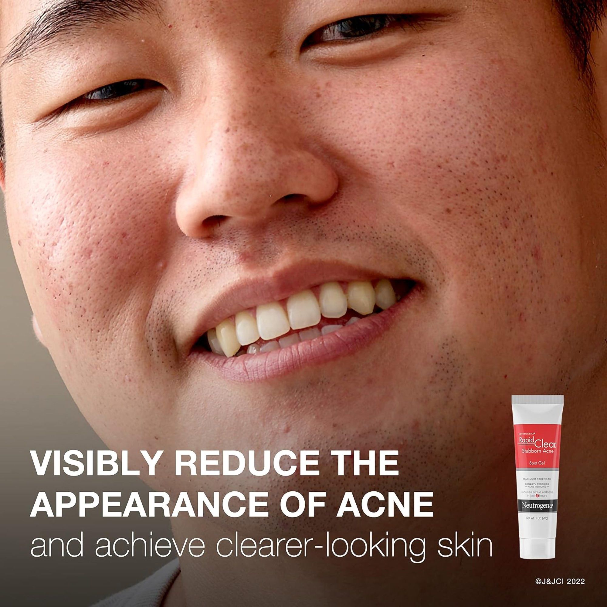 Neutrogena Rapid Clear Stubborn Acne Medication Spot Treatment Gel ...