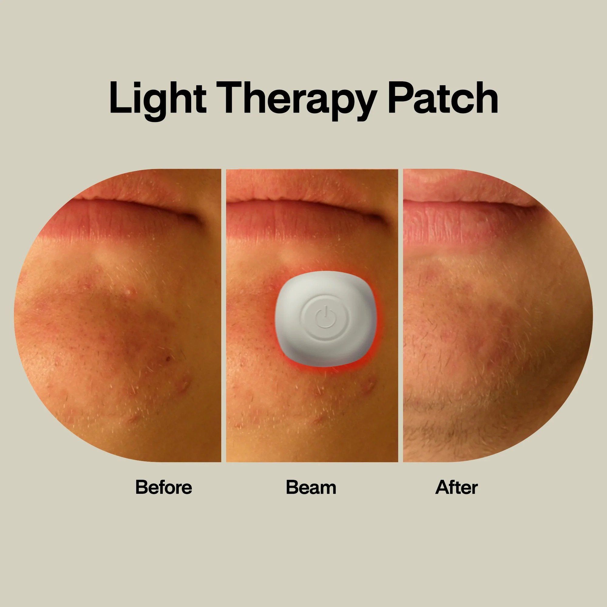 lab Acne Light Therapy Patch - 1 pack