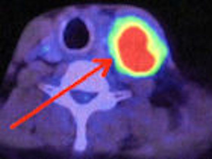 Cancer: Types, Causes, Treatment, and Prevention