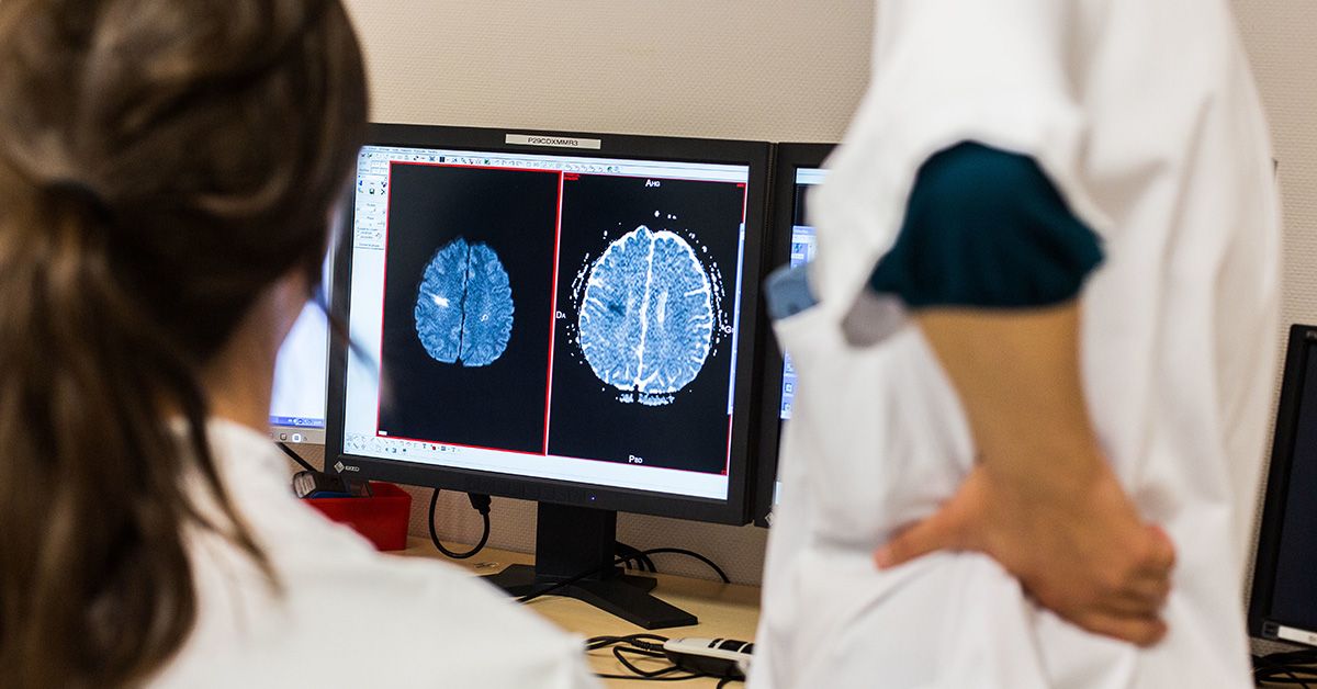 Thrombotic Stroke: Vs. Embolic, Symptoms, Treatment, and More