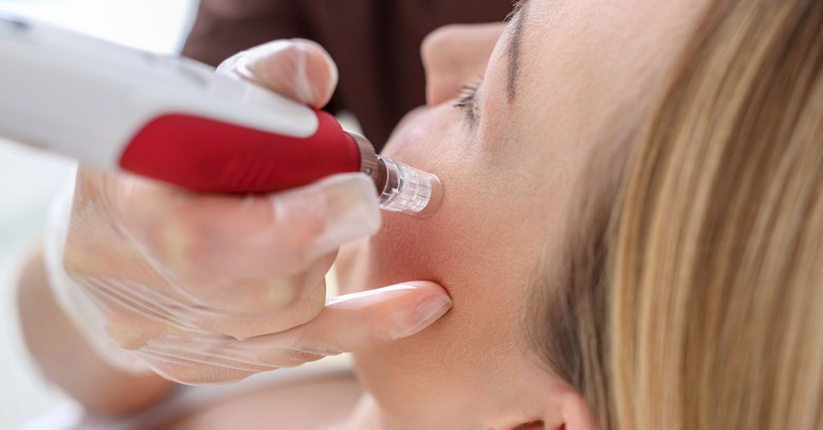 Microneedling for Acne Scars: Effectiveness, Side Effects, and Costs