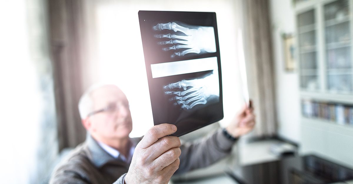 Cheilectomy of Big Toe: Purpose, Surgery, Recovery, Complications