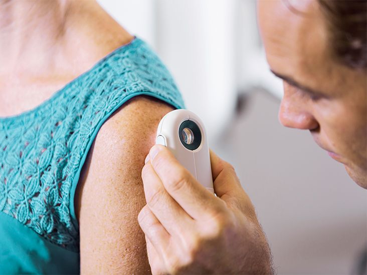 Stage 4 Squamous Cell Carcinoma: Prognosis and Outlook