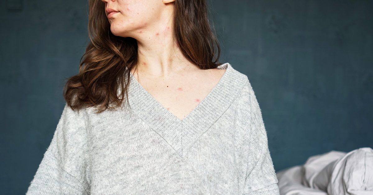 6 Things to Know About IUDs and Acne: Triggers, Treatment, and More
