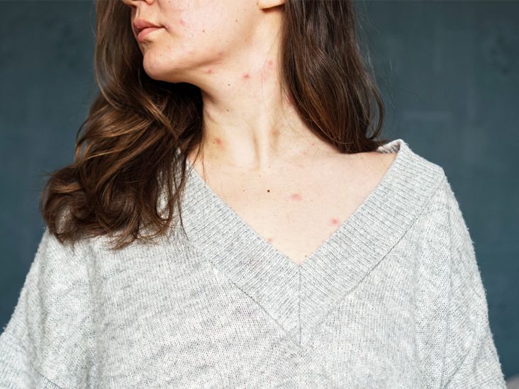 6 Things to Know About IUDs and Acne: Triggers, Treatment, and More