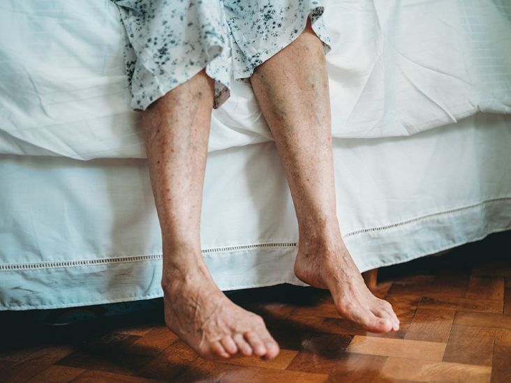 Polycythemia Leg Pain: Treatment and Prevention