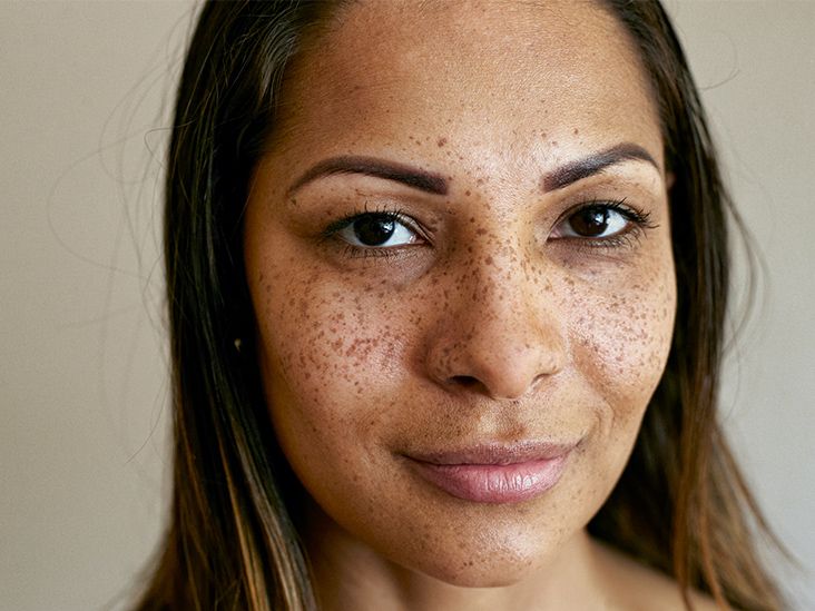 Anicteric Sclerae vs. Icteric Sclerae: What They Mean About Eye Health