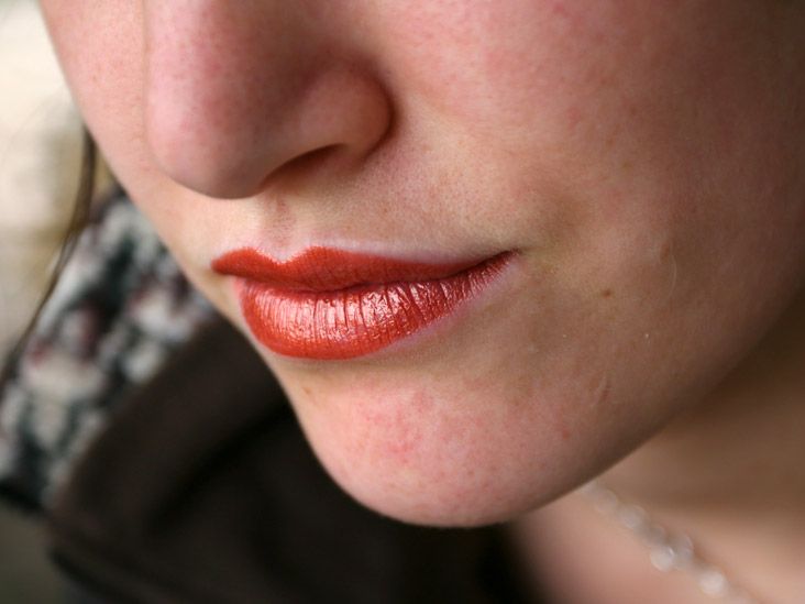 Llagas bucales causadas por el VIH: Cómo son y cómo se tratan