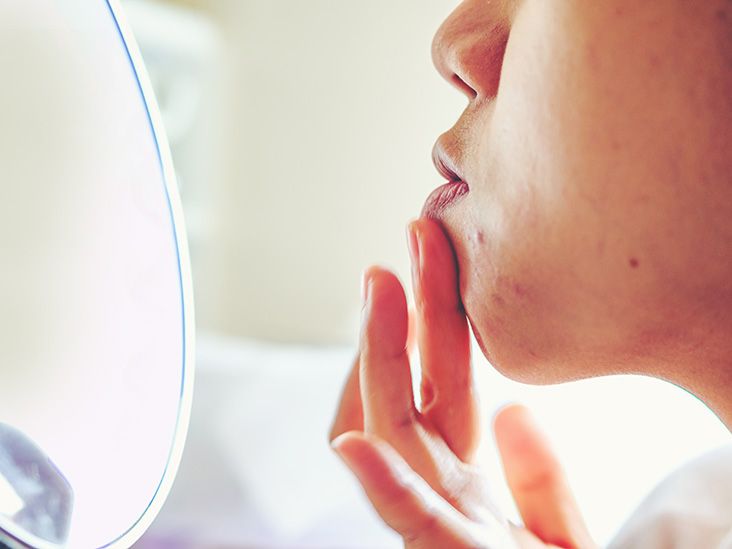 Cortisone Shot for Acne: Benefits & Side Effects