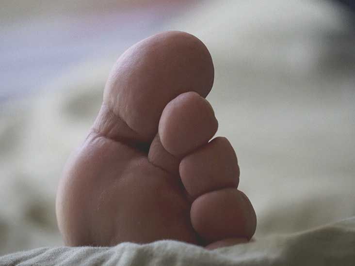 Hammer Toe: Causes, Symptoms, and Diagnosis