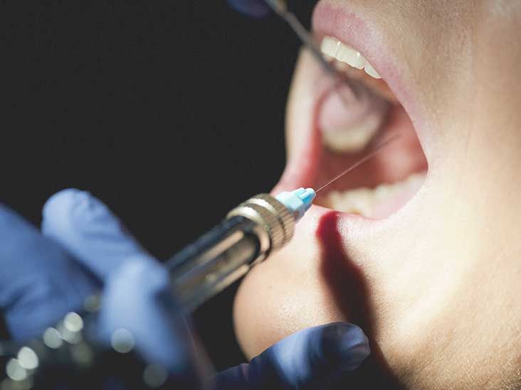 How Long Does Novocaine Last: Side Effects and More