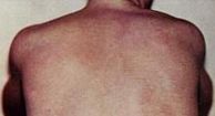 Dengue Fever: Symptoms, Complications & Diagnosis