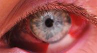 Bleeding Under Conjunctiva (Subconjunctival Hemorrhage)