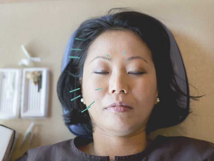 Acupuncture for Headaches and Migraine: How It Works
