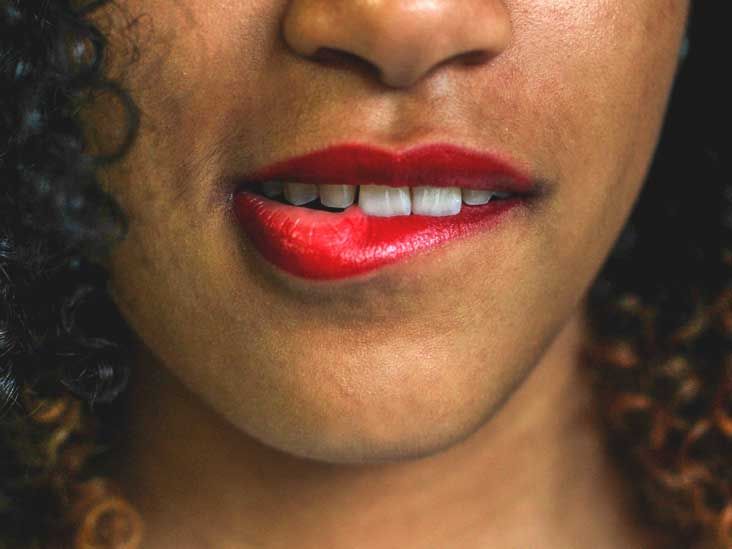 Chipped Tooth: Causes, Treatment, Recovery