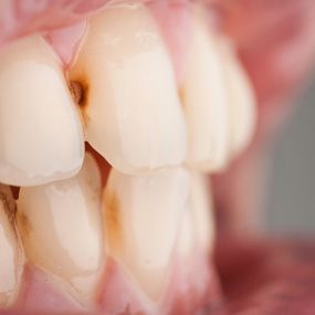 How Bulimia Impacts Your Dental Health
