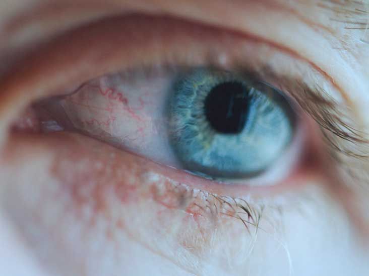 Episcleritis: Symptoms, Causes, and Treatment
