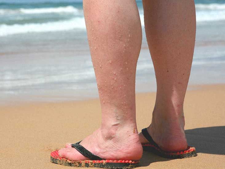 Post-Thrombotic Syndrome: Treatment, Symptoms, and Pain Management