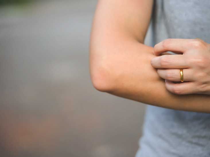 Sézary Syndrome: Symptoms, Causes, and Treatment