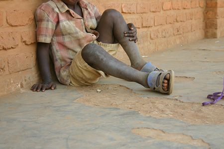 Leishmaniasis: Causes, Diagnosis, & Treatment