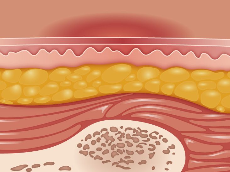Stages of Pressure Ulcers: Stages, Treatments, and More