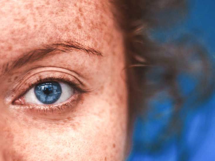 Exophoria: Definition, Treatment, and How It Compares to Exotropia