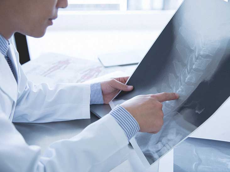 Scrofula: Definition, Pictures, and Symptoms