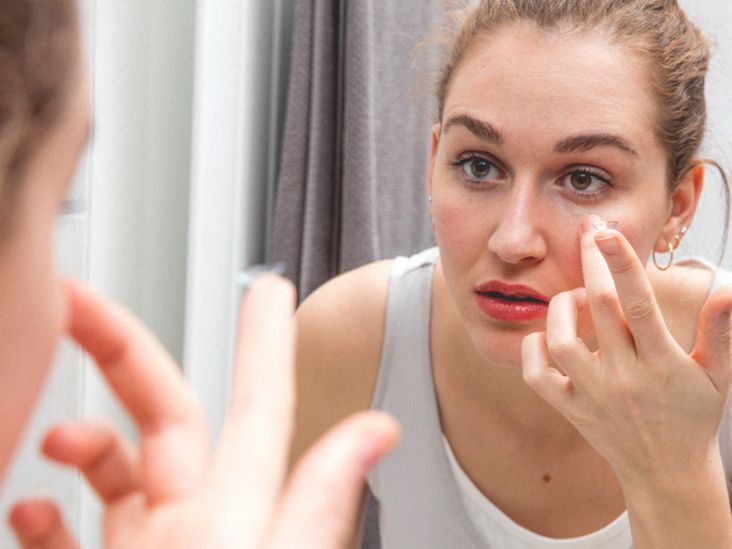 Giant Papillary Conjunctivitis: Stages, Treatment, and Remedies