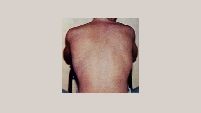 Dengue Fever: Symptoms, Complications & Diagnosis