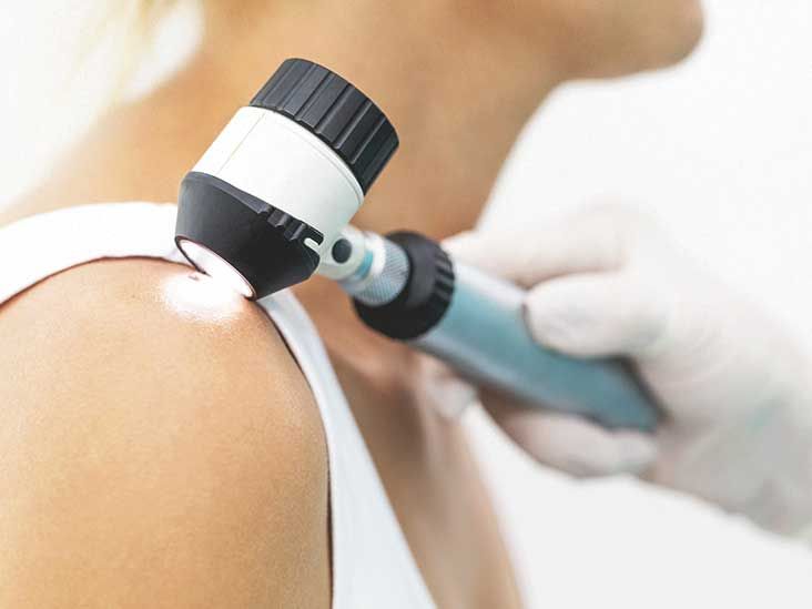 Acral Lentiginous Melanoma: Symptoms, Prognosis, and More