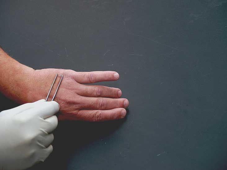 Filiform Warts: Pictures, Treatment, and More