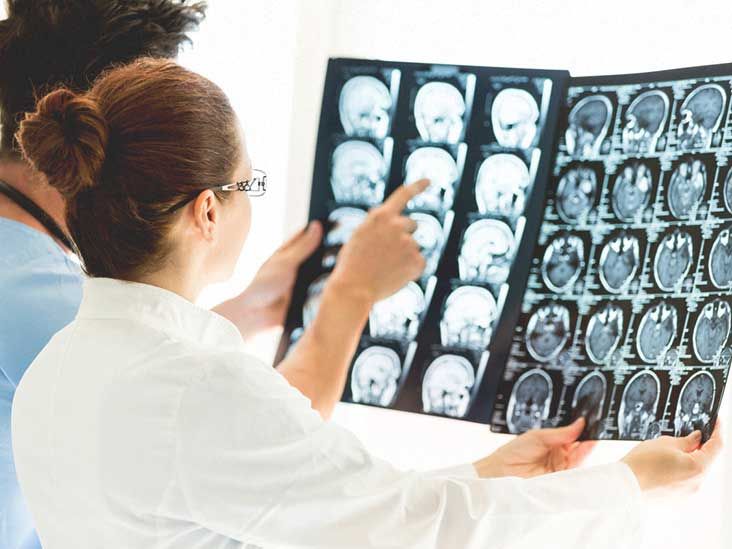 Glioblastoma: Survival Rates, Treatments, and Causes