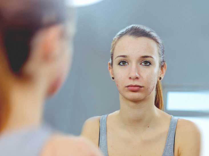 How Stress Affects Acne