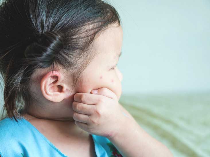 Papular Urticaria: Symptoms, Causes, and More