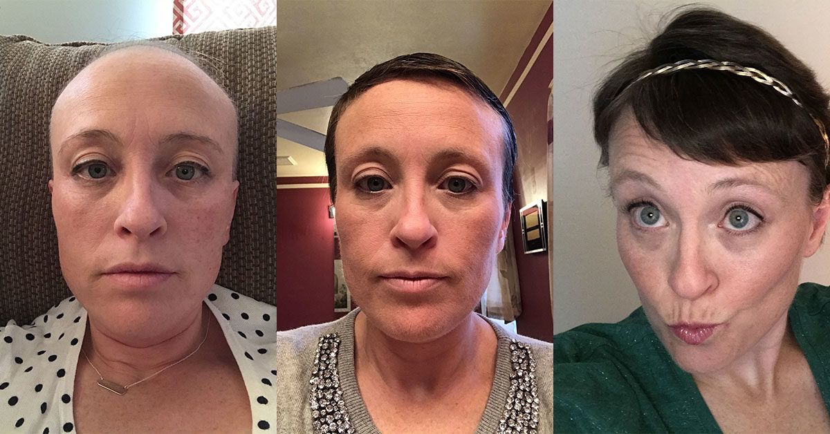 Hair Growth After Chemotherapy: Pictures and the Process