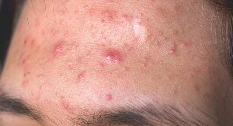 How Do Pimples Form? Causes, Types, and More