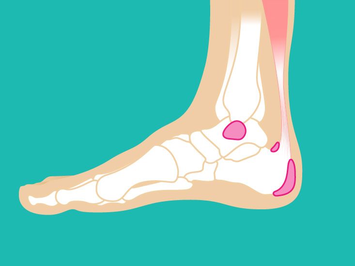Bursitis: Ankle Bursa, Care, and Prevention