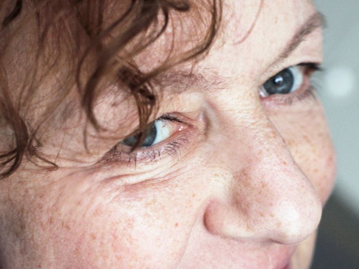 Heavy Eyelids: Causes and Home Remedies