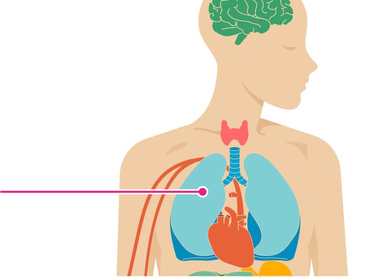 How Does Lupus Affect the Body?
