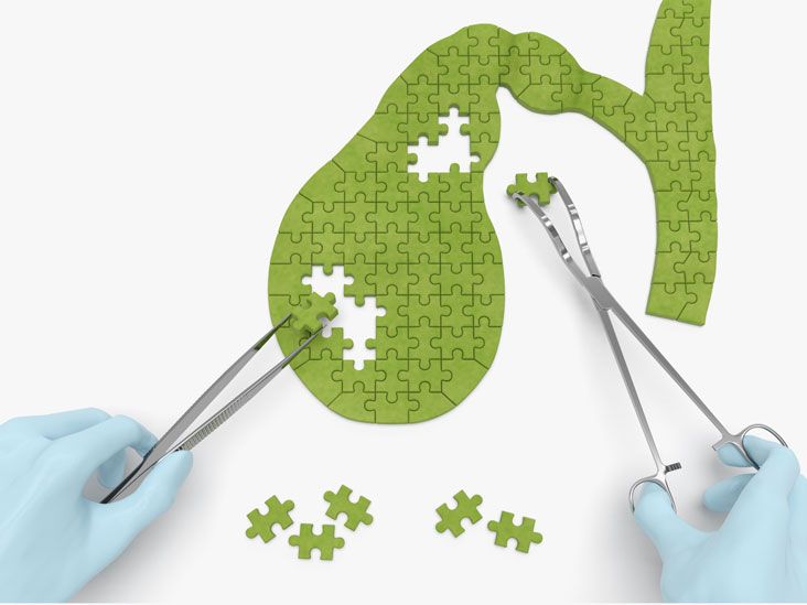 Gallbladder Radionuclide Scan: Uses, Risks, and Procedure