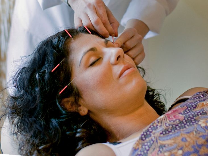 Acupuncture for Hair Loss: Is it Effective?