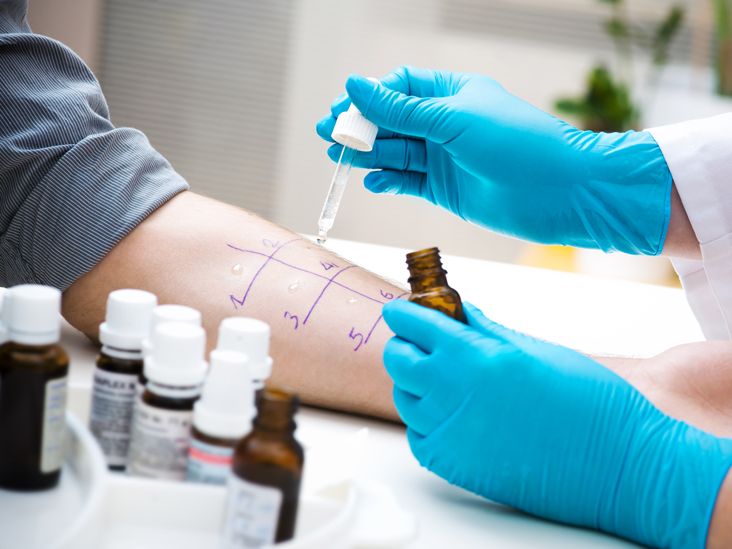 Allergy Testing: Purpose, Procedure, and Results