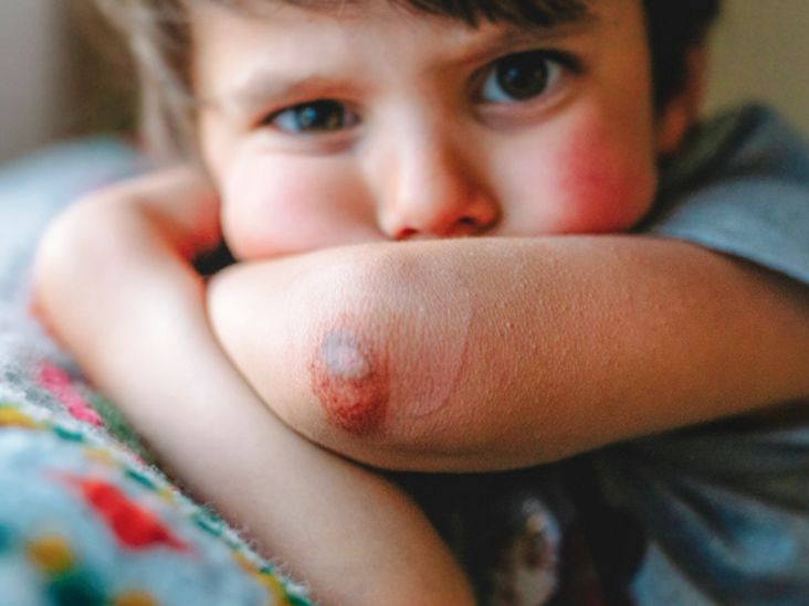 Bruised Elbow: Causes, Symptoms, Treatment, and Healing Time