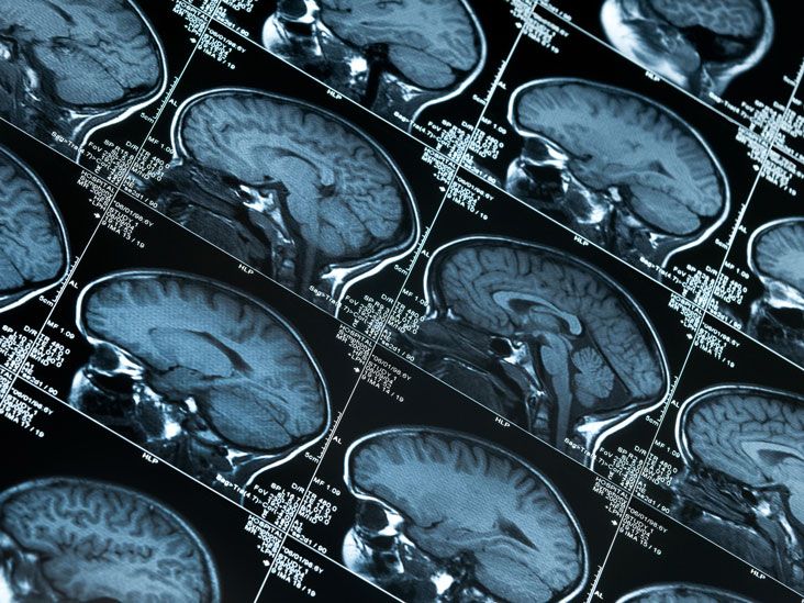 Brain Surgery: Purpose, Types, and Risks