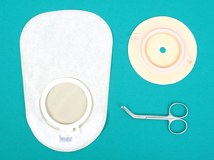 Colostomy: Purpose, Risks, Procedure, Follow-Up Care