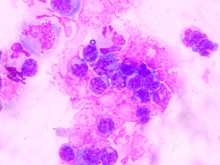 CSF Cell Count and Differential