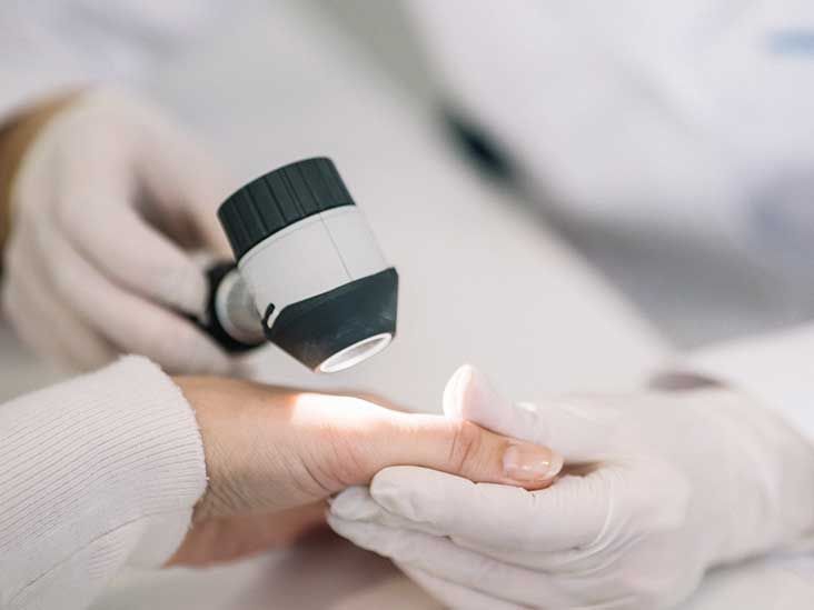 Calcinosis Cutis: Treatment, Diagnosis, Causes, and Symptoms