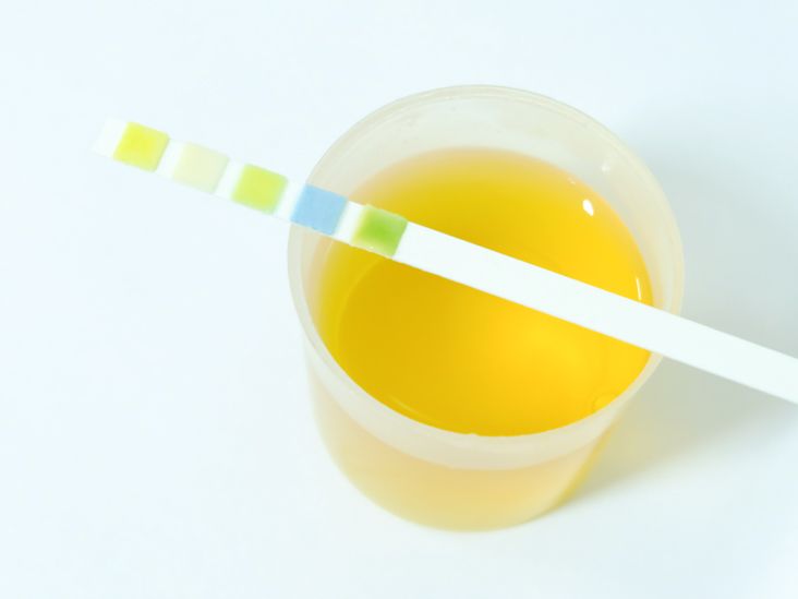 Urine Osmolality Test: Purpose, Procedure, and Results