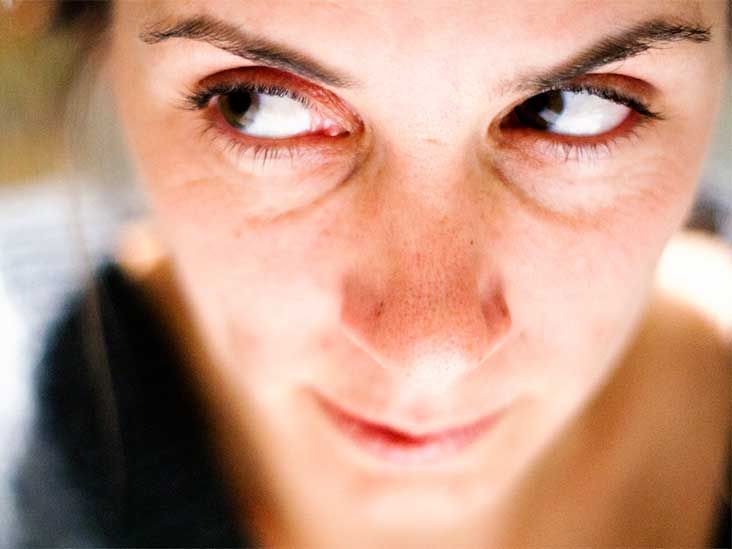 Raccoon Eyes: Basilar Skull Fracture and Treatment