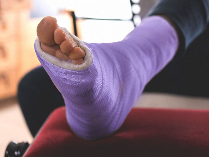 Broken Foot Symptoms: What to Expect